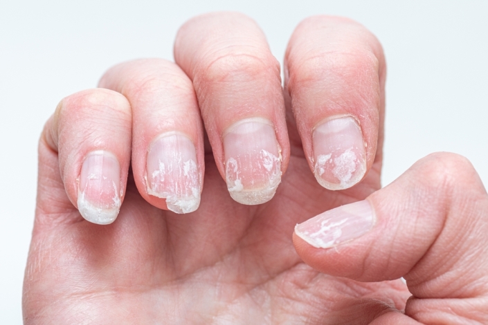 Nail Infections – Dr Aisha Ghias